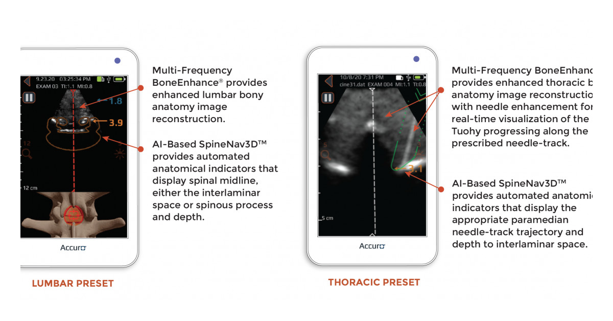 RIVANNA Launches Accuro Second Generation With BoneEnhance® Multi ...