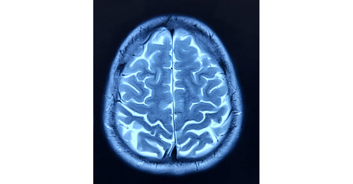 Biodexa's MX-110 Continues to Show Promise in Recurrent Glioblastoma ...