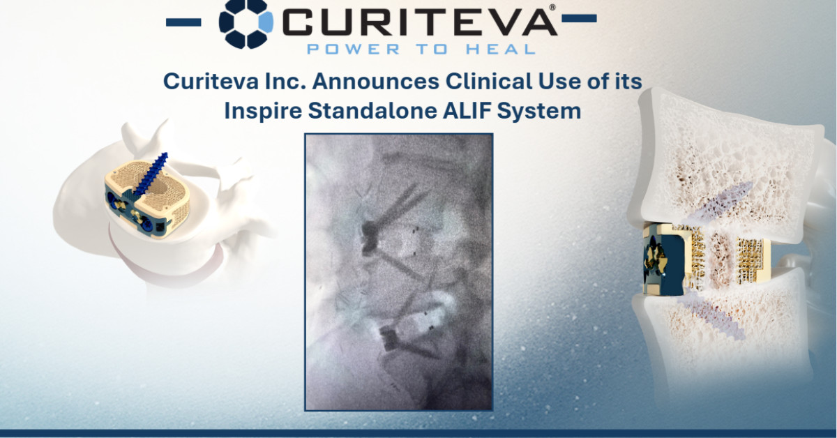 Curiteva Announces First Clinical Use of Inspire Standalone ALIF System ...