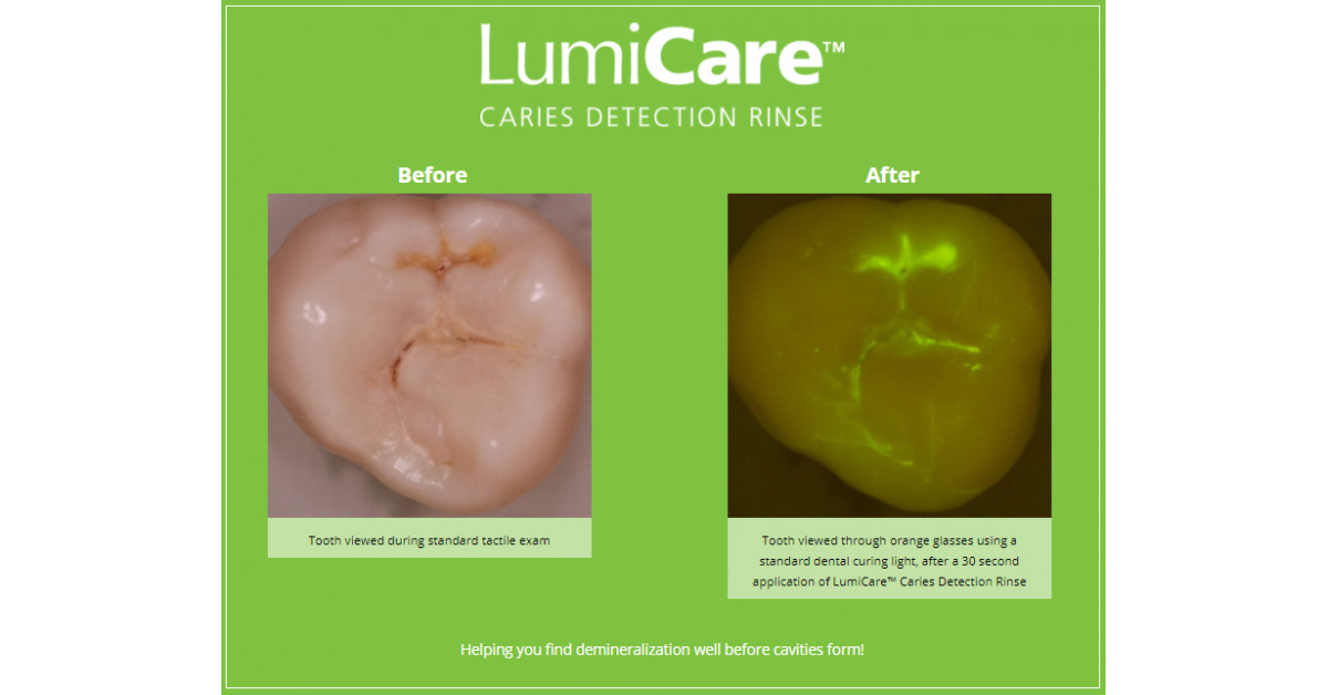 GreenMark Secures FDA Clearance for LumiCare™ Caries Detection Rinse ...