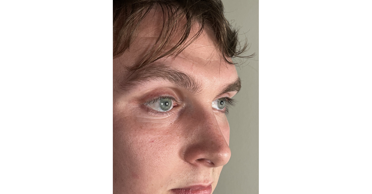 Breakthrough: Patients and Ocularists Impressed by Quality of Computer ...